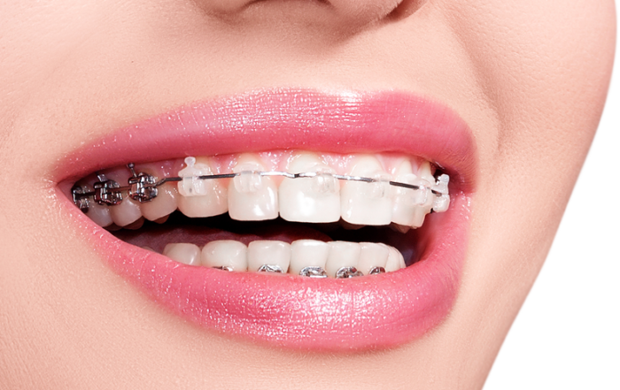 Orthodontist in Atlanta GA 30318 | Braces & Invisalign | ATL Orthodontist
